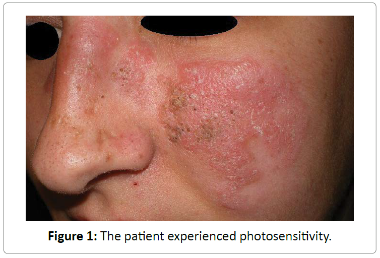 Acneiform Presentation of Chronic Cutaneous Discoid Lupus Erythematosus ...